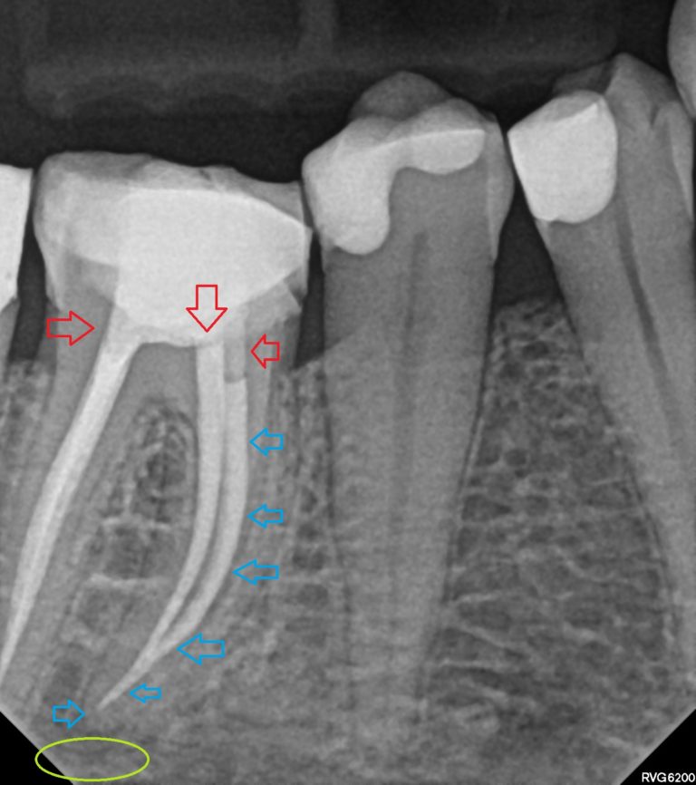 Rotfylling - Rotbehandling | Vinterbro Tannlegesenter